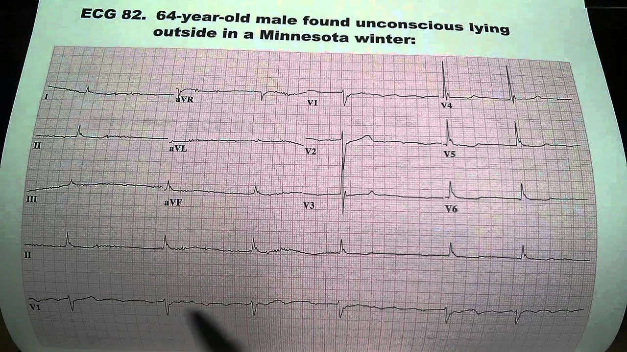 unconscious Minnesota winter ekg ecg - YouTube