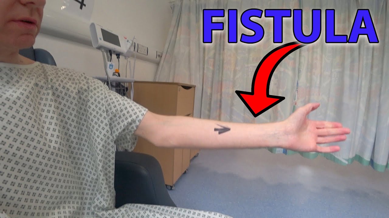 Having a Fistula procedure (before and after) - YouTube