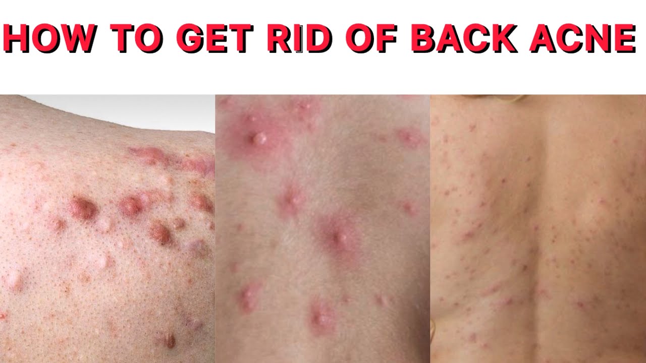 POWERFUL REMEDY FOR BACK ACNE || HOME REMEDY TO GET RID OF BACK ACNE ...