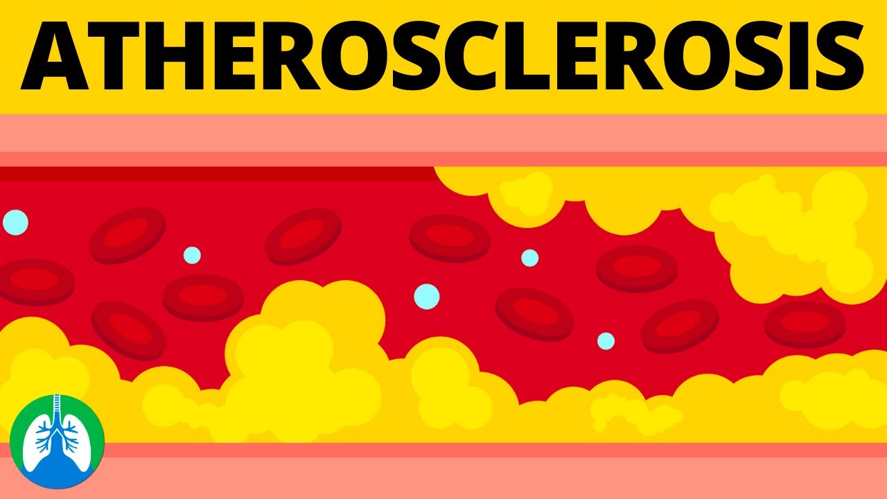 Atherosclerosis (Medical Definition) | Quick Explainer Video - YouTube
