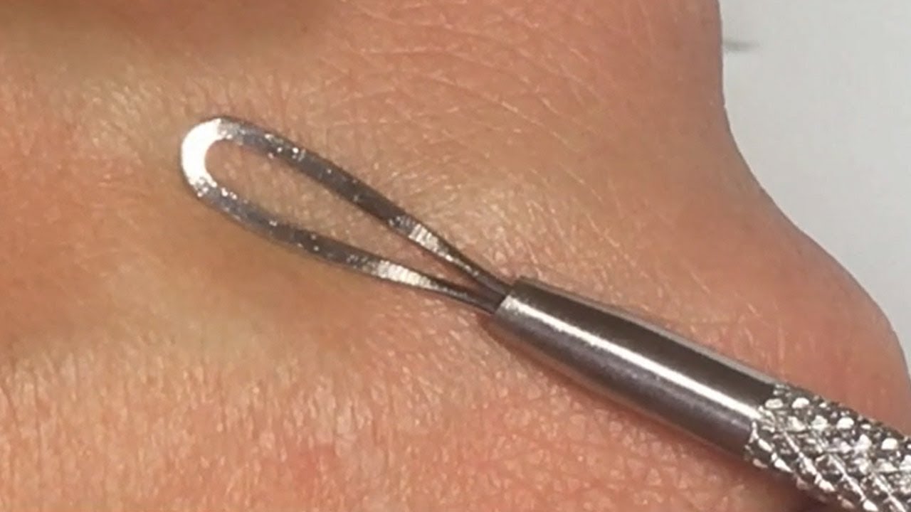 Do Comedone Extractors Work? - YouTube