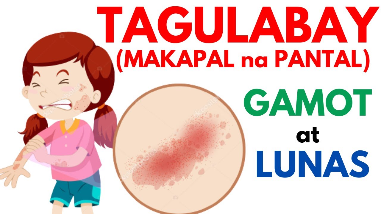 TAGULABAY o HIVES - Gamot at LUNAS | Mapulang pantal sa mga BATA at ...