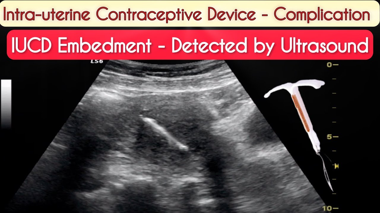 Intra-Uterine Contraceptive Device - IUCD Complication | Ultrasound ...