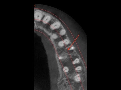CBCT & selective re RCT - YouTube