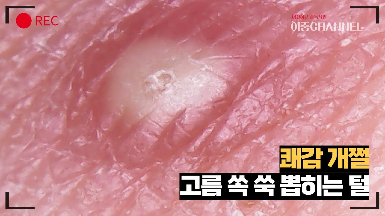 쾌감 개쩔, 고름 속 쏙 뽑히는 털 ingrown hair in pus - YouTube