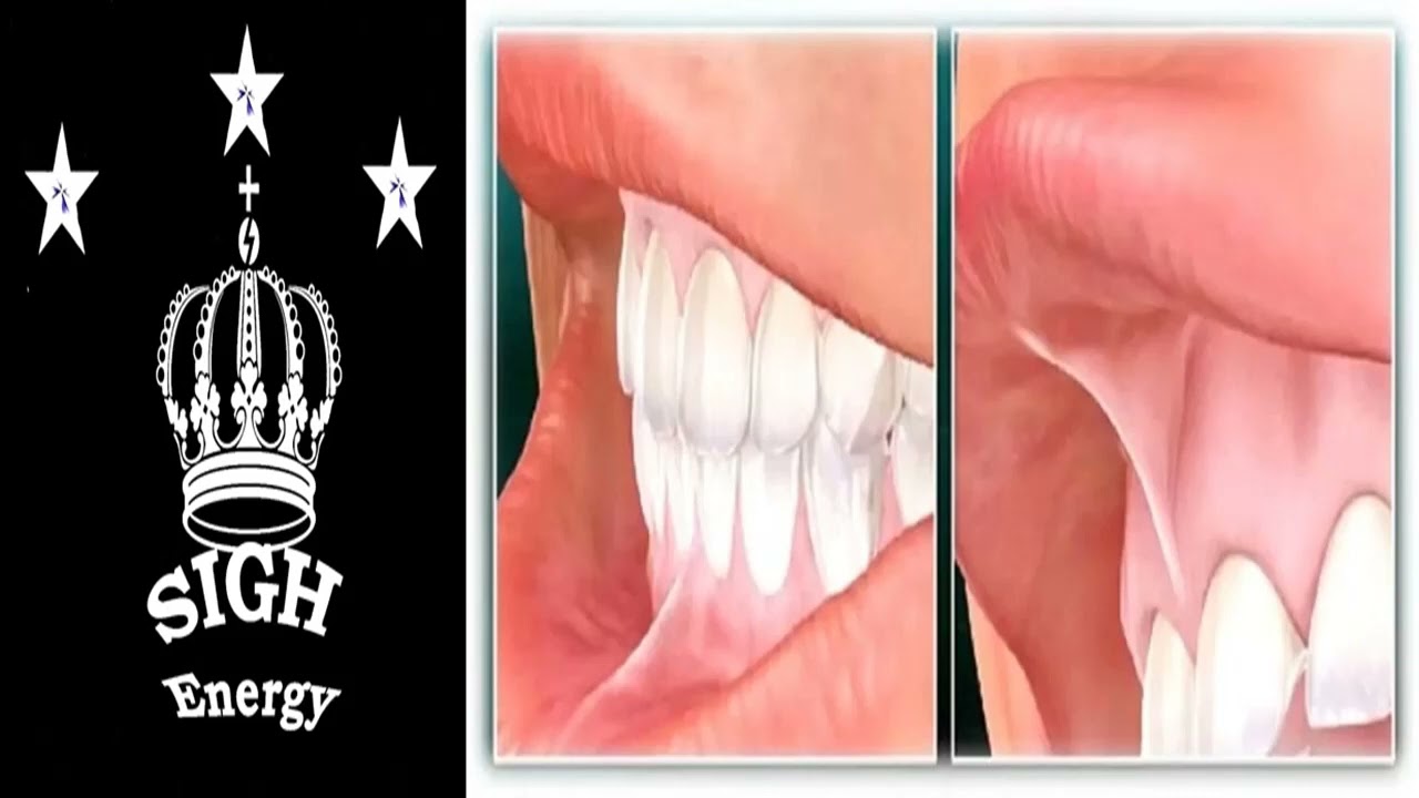 Adult Lip Tie Removal EXTREMELY POWERFUL!!! (Energetically Programmed ...