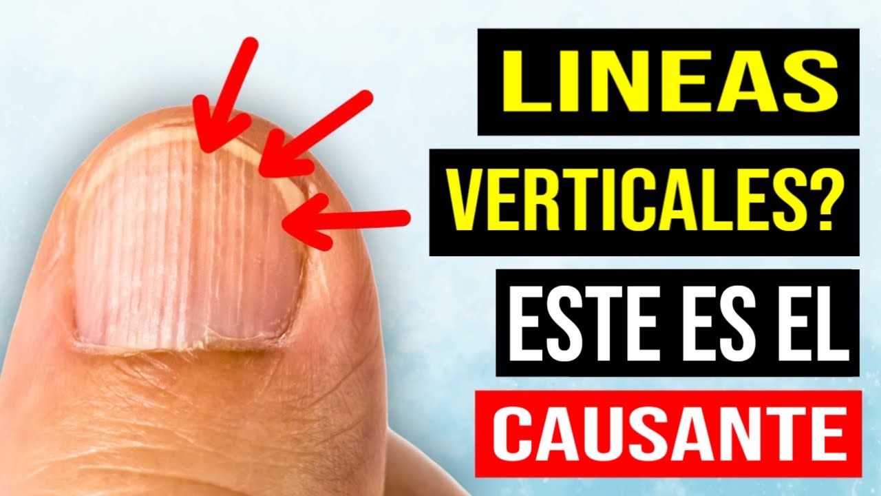 Causa de las lineas verticales en las uñas - YouTube