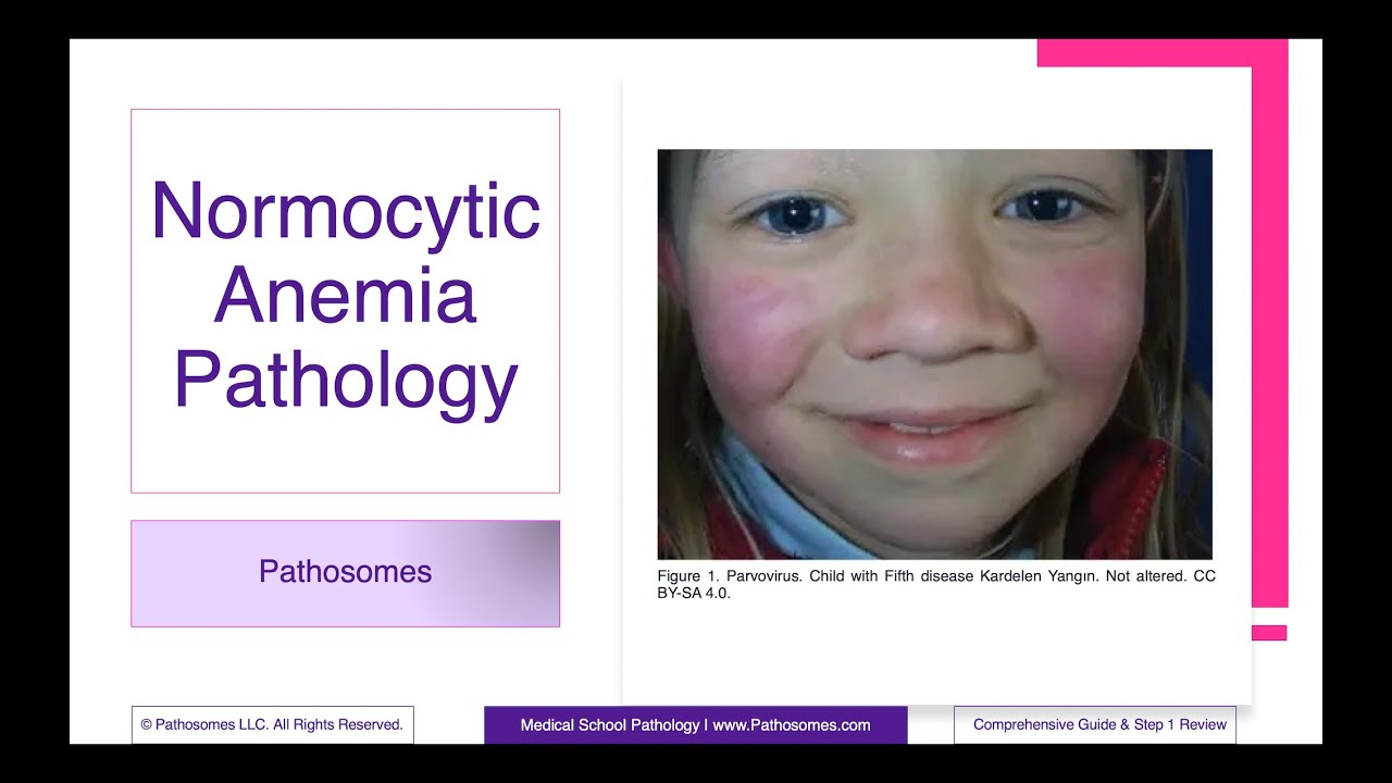 Normocytic Anemia Pathology | Comprehensive Guide & Step 1 Review ...