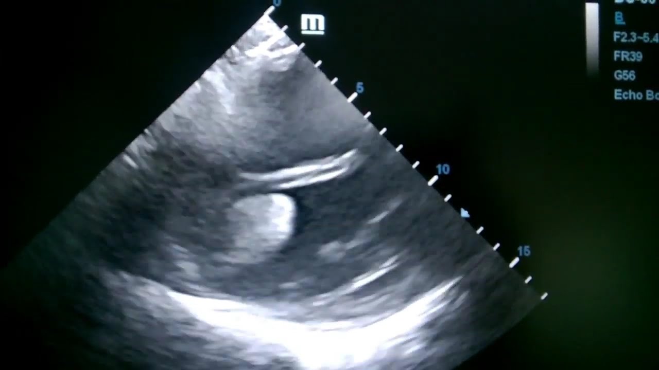 Amazing intraventricular thrombosis with a floating thrombus of the ...