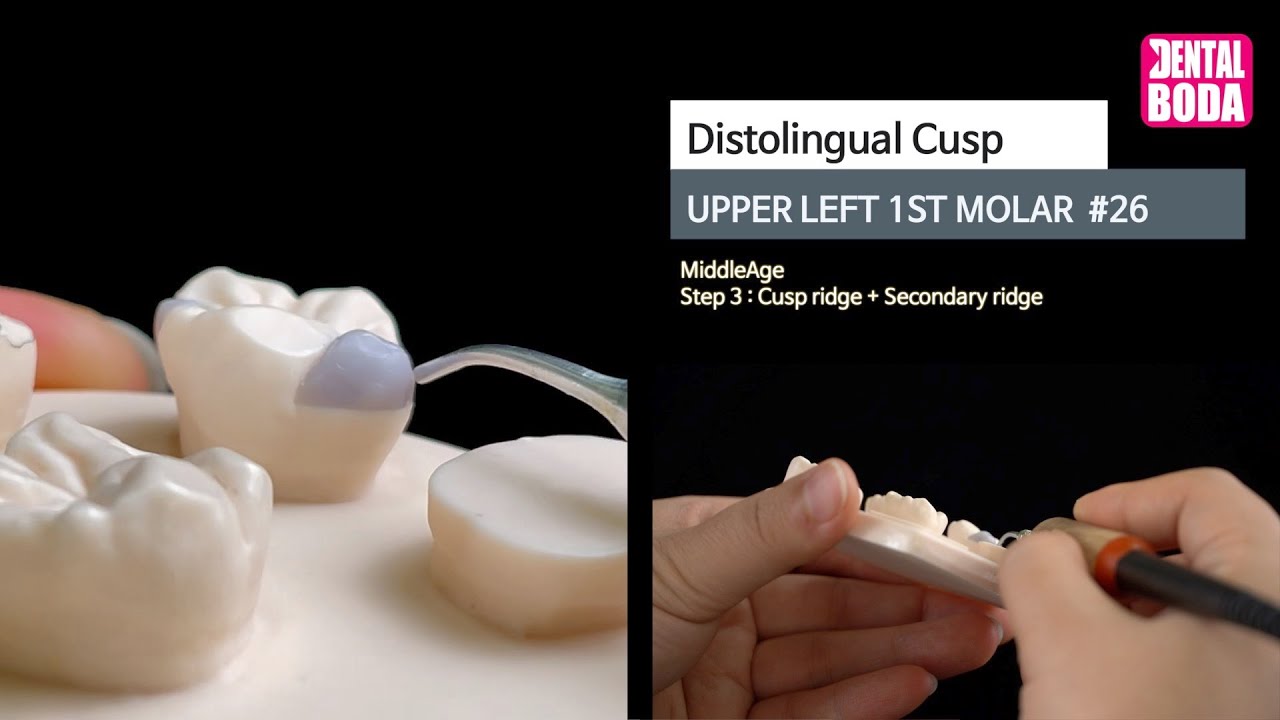 Upper Left 1st Molar distolingual cusp 3 ridge (middle-aged) Wax-Up #26 ...