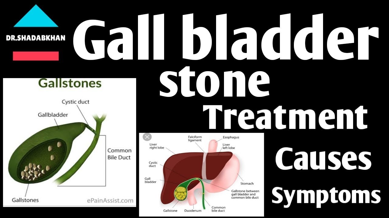 Gall bladder stone Treatment , causes , symptoms || Homoeopathic ...