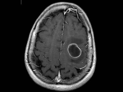 ring enhancing lesion of the brain - YouTube