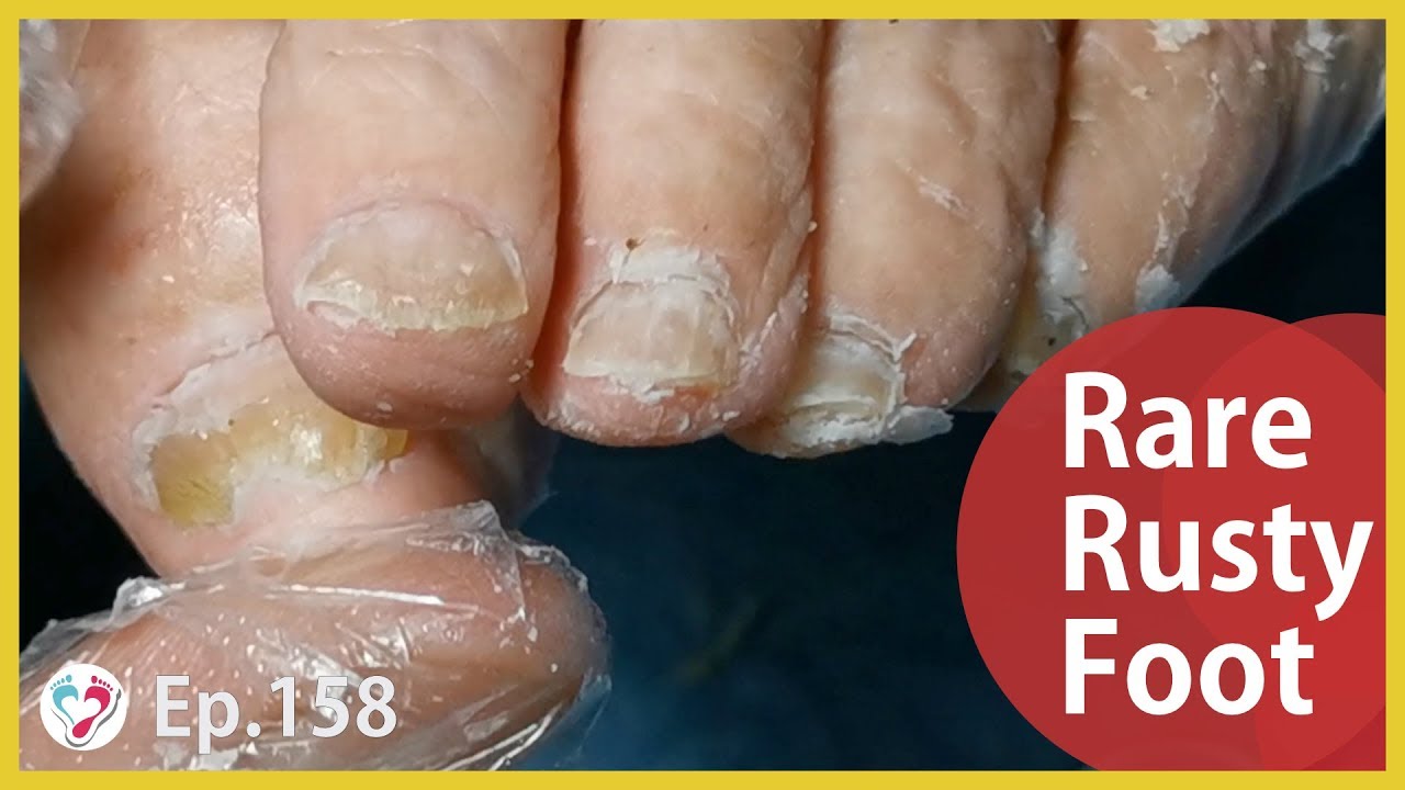 TOP MEDICAL PEDICURE Ep.158 - Pedicure for Rare Very Rusty Foot - YouTube