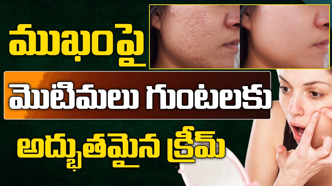 How to Remove Pimples Naturally at Home | Acne Treatment at Home ...