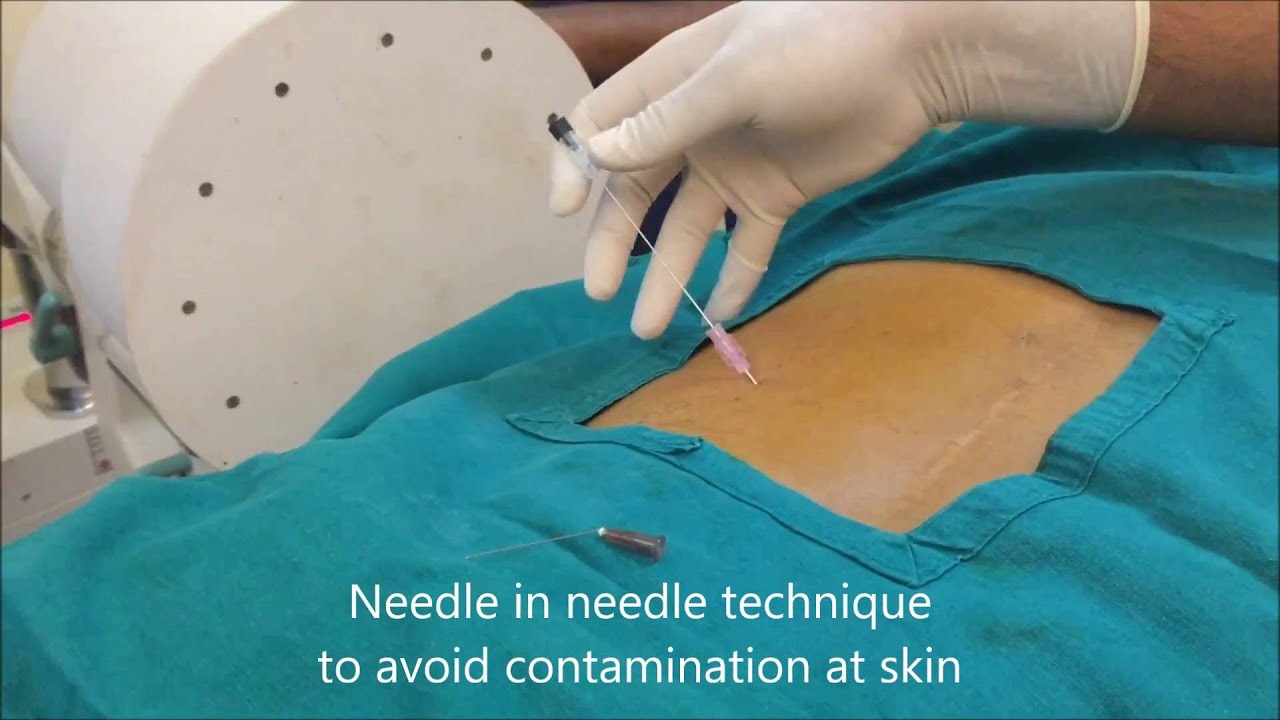 Lumbar Ozone Discectomy Technique - YouTube