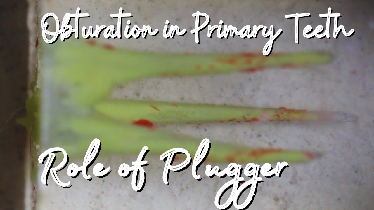 Obturation in Primary Teeth 🔴 Role of Plugger 🟢 - YouTube