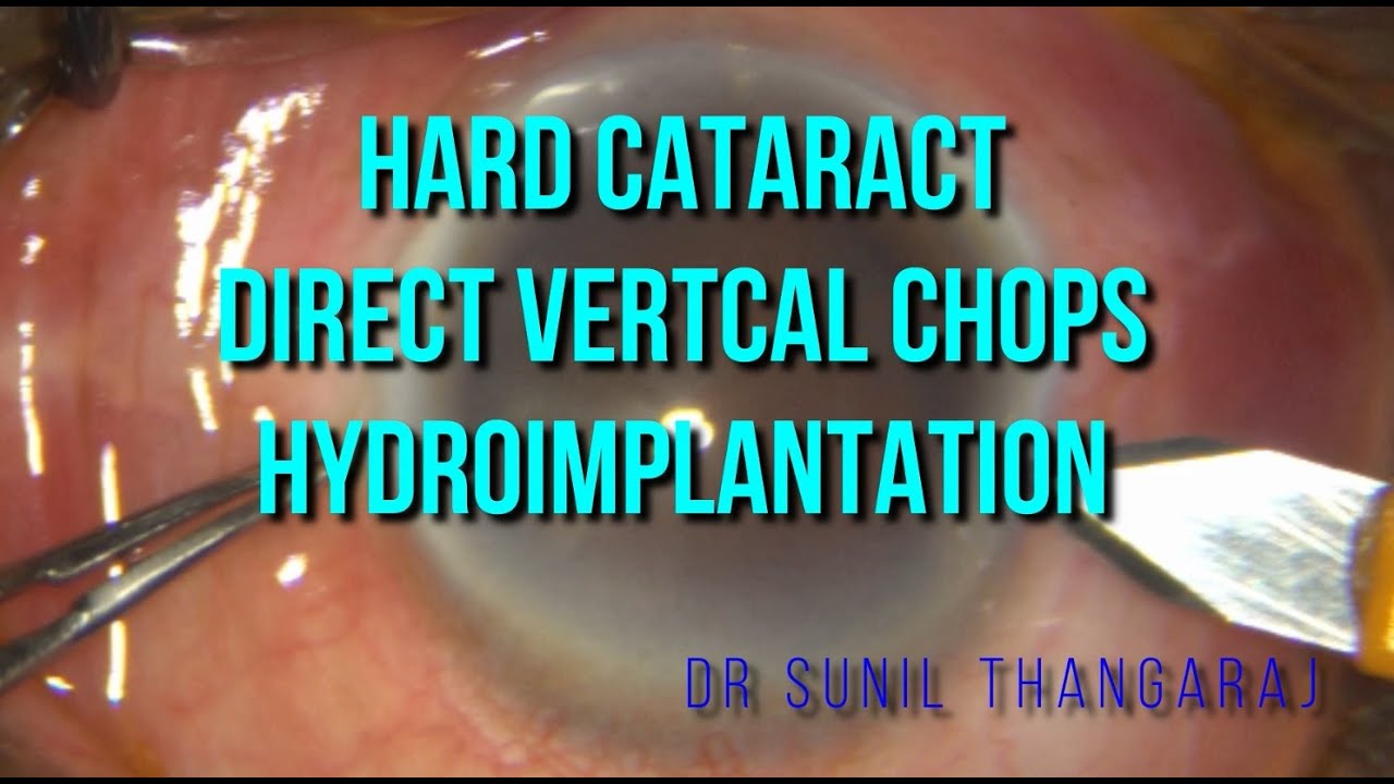 Hard cataract using direct vertical chops - YouTube