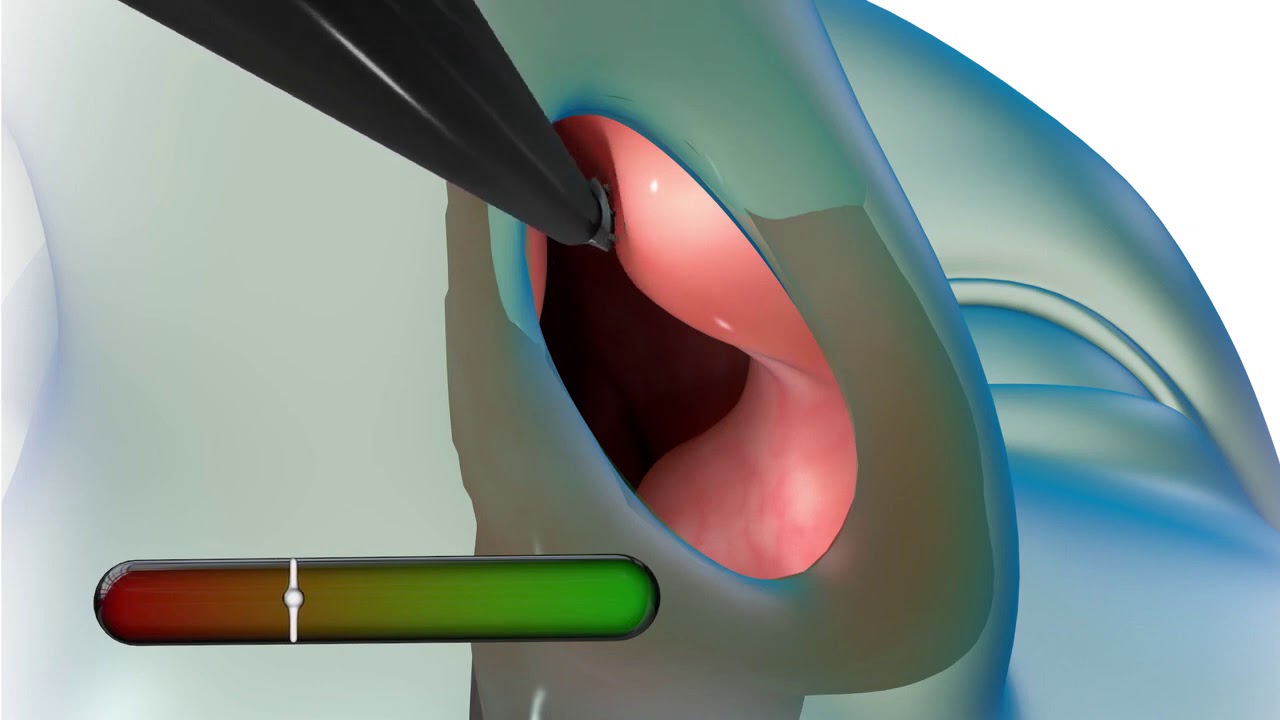 Reshaping Nasal Airflow For Better Breathing With VivAe - YouTube