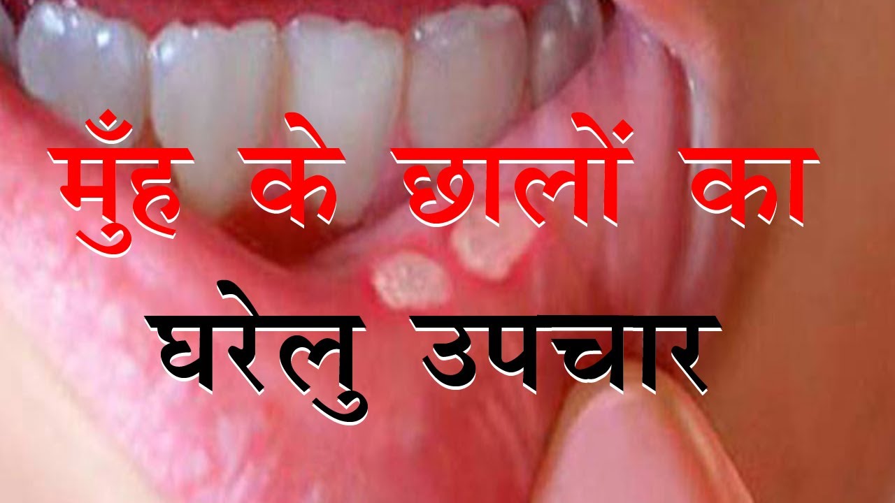 Muh chale thik karne ke gharelu upaye | Health Care Hindi Tips - YouTube