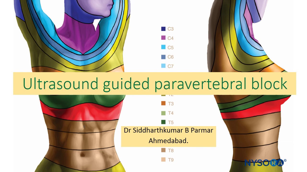 Lecture-presentation: Ultrasound guided paravertebral block - YouTube