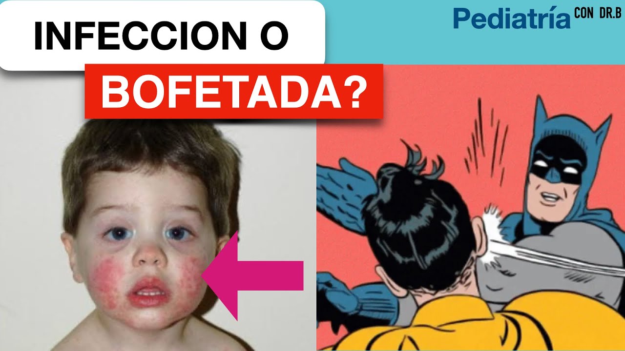 La Enfermedad del bofetón? - YouTube