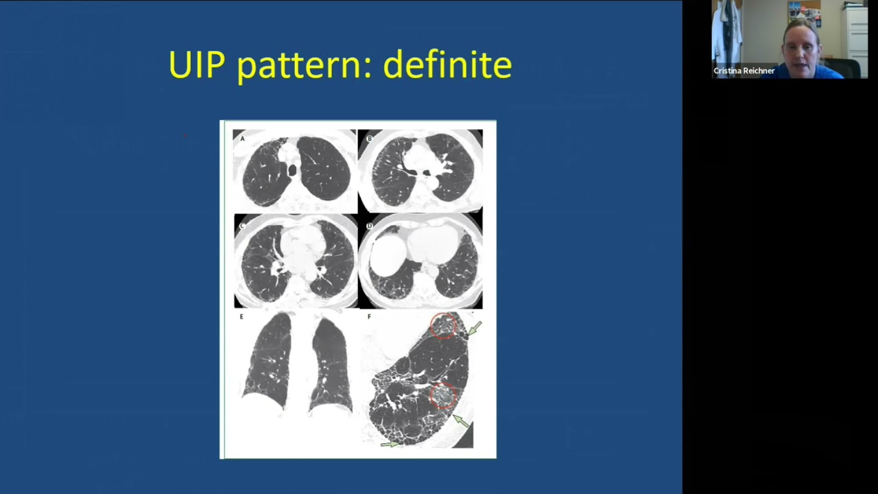 Interstitial Lung Disease (ILD) - YouTube