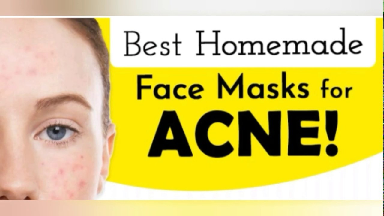 Homemade Acne Face Mask | How to remove pimples | Something Special ...