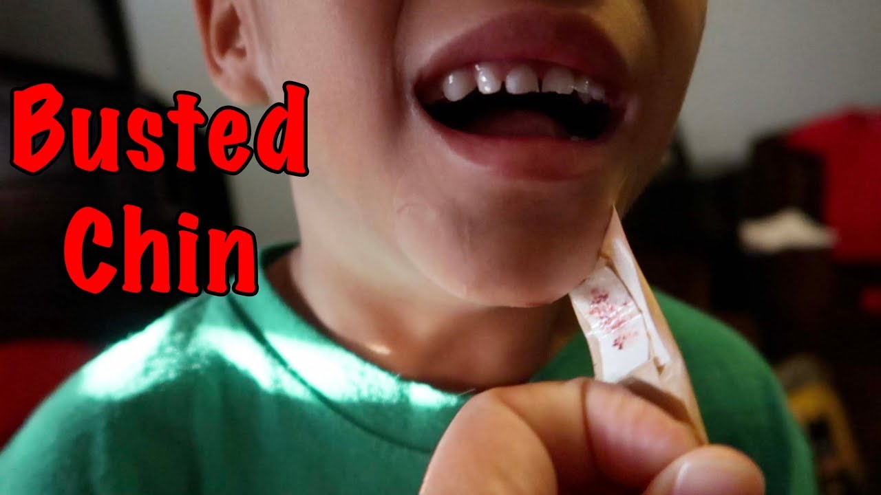 BUSTED CHIN and GETTING RID OF SLIME DAY VLOG (Sept. 27, 2017) - YouTube