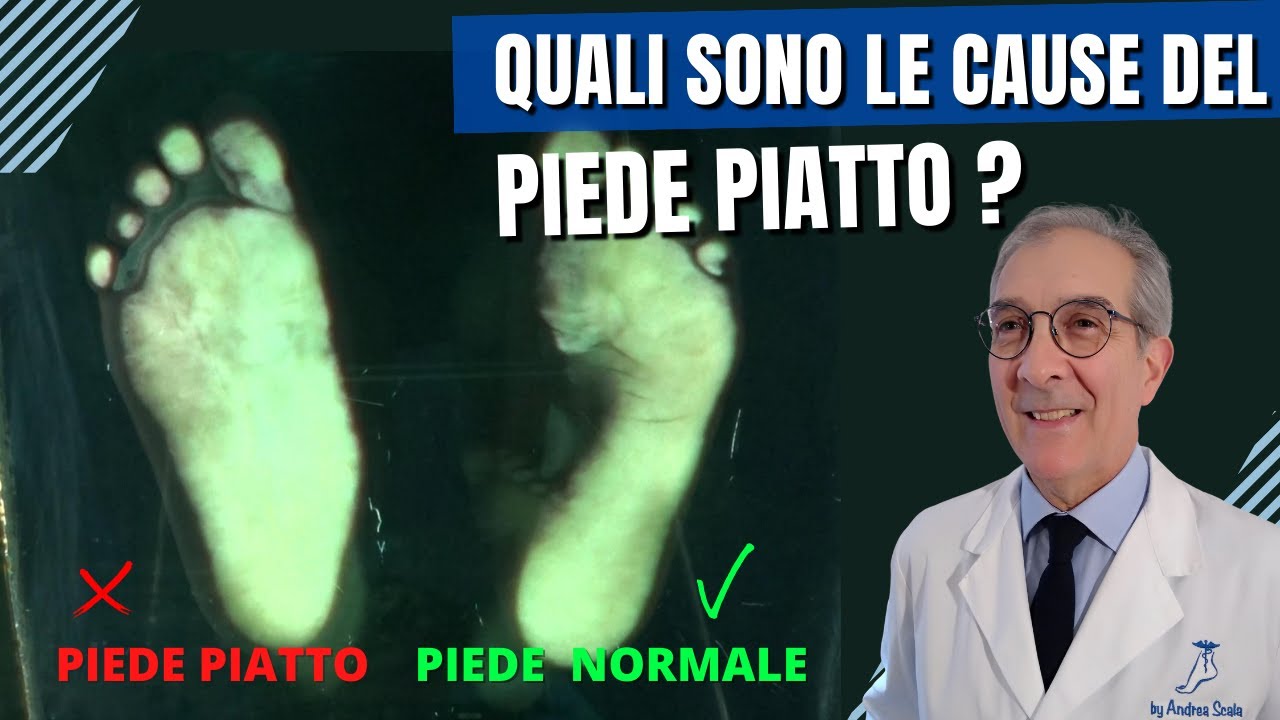Piede piatto nell' adulto cos'è e come si cura | Che problemi comporta ...