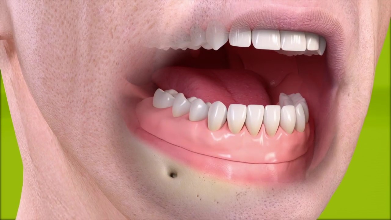 Uitneembare gebitsprothese met drukknoppen - YouTube