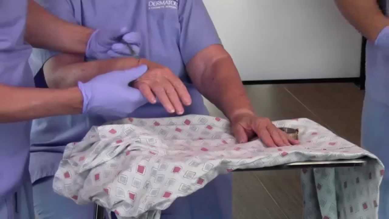 Dr. Jochen explains one of the best treatments for hand rejuvenation ...