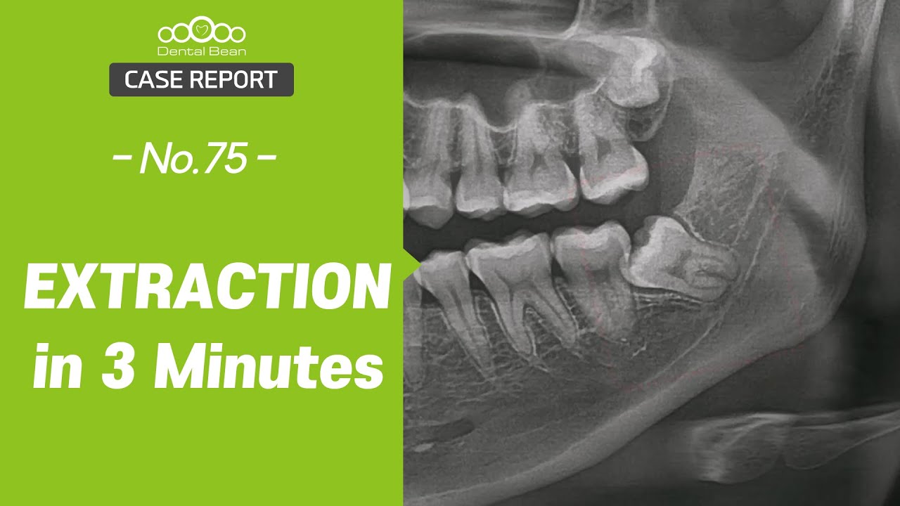 [MULTI_SUB] Extraction of mesioangular Lt. MN third molar [Dr. Cho ...