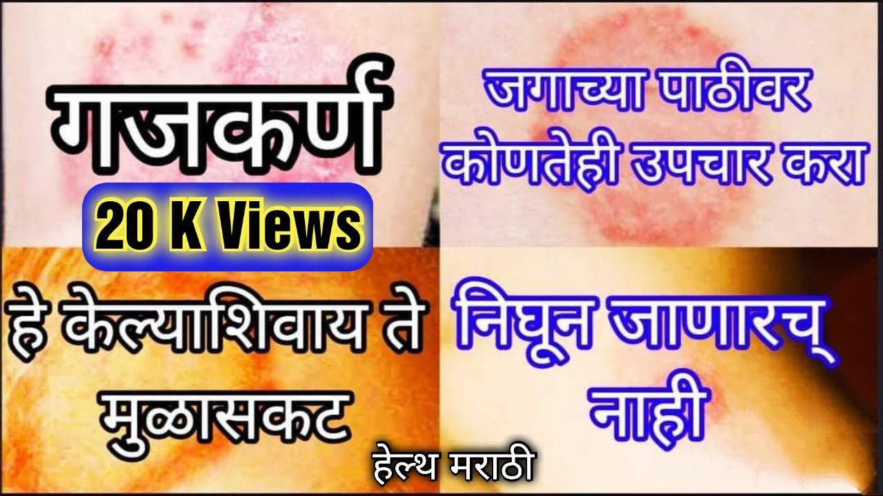 गजकर्णासाठी कायमस्वरूपी उपाय|gajkarn gharguti upay@dr_HukireSV - YouTube