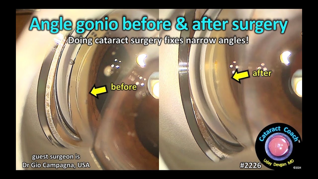 CataractCoach™ 2226: angle gonio before and after cataract surgery ...