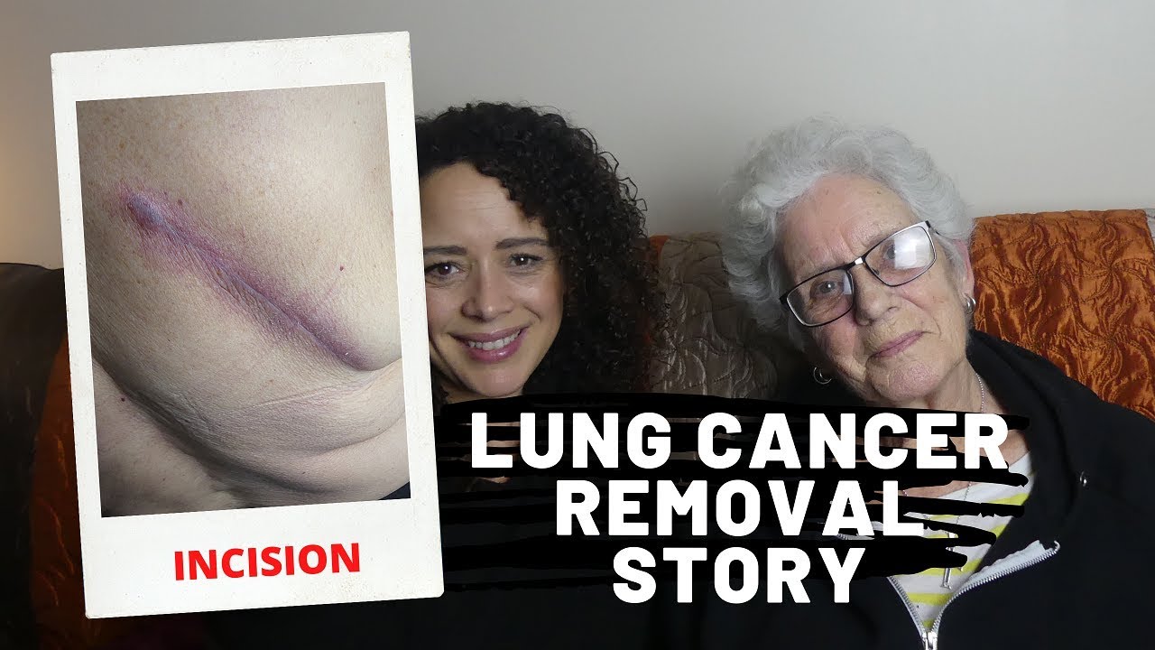 CHATTING WITH MUM ABOUT HER LUNG CANCER SURGERY RECOVERY & INCISION ...