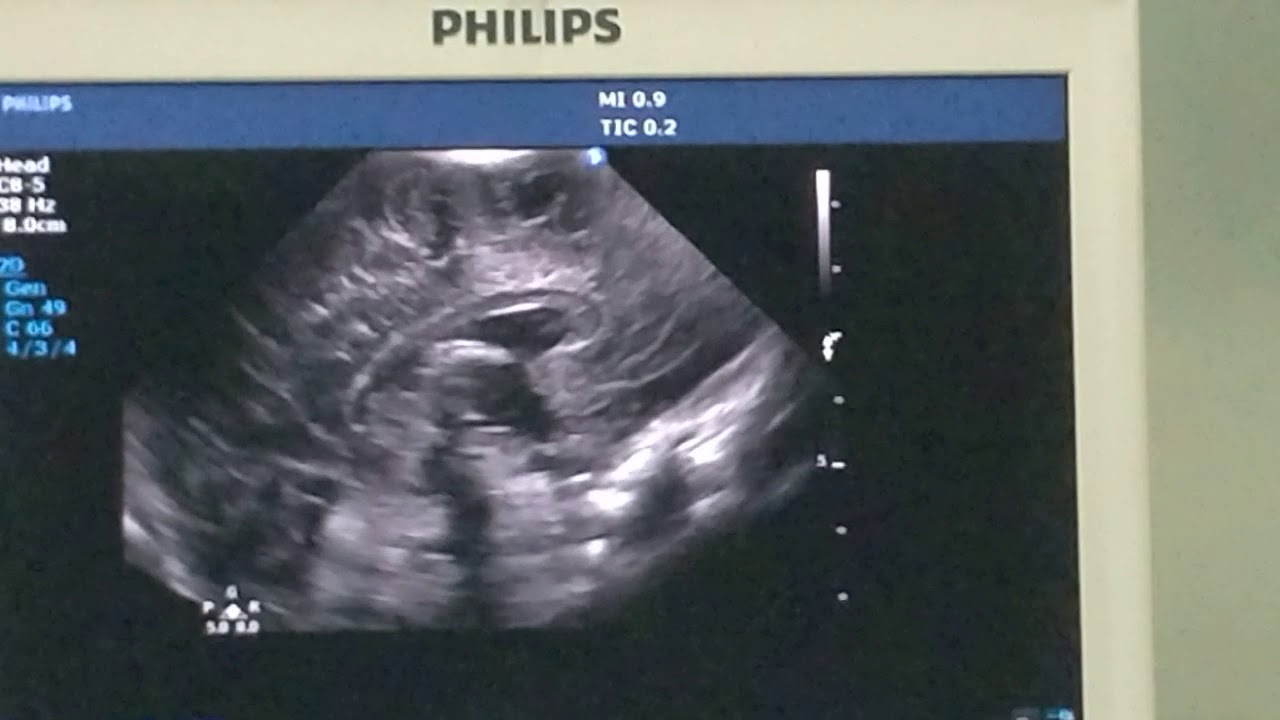 Neonatal brain ultrasound - YouTube