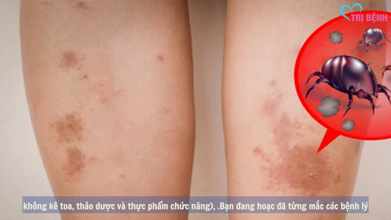Thuốc Acarosan - YouTube