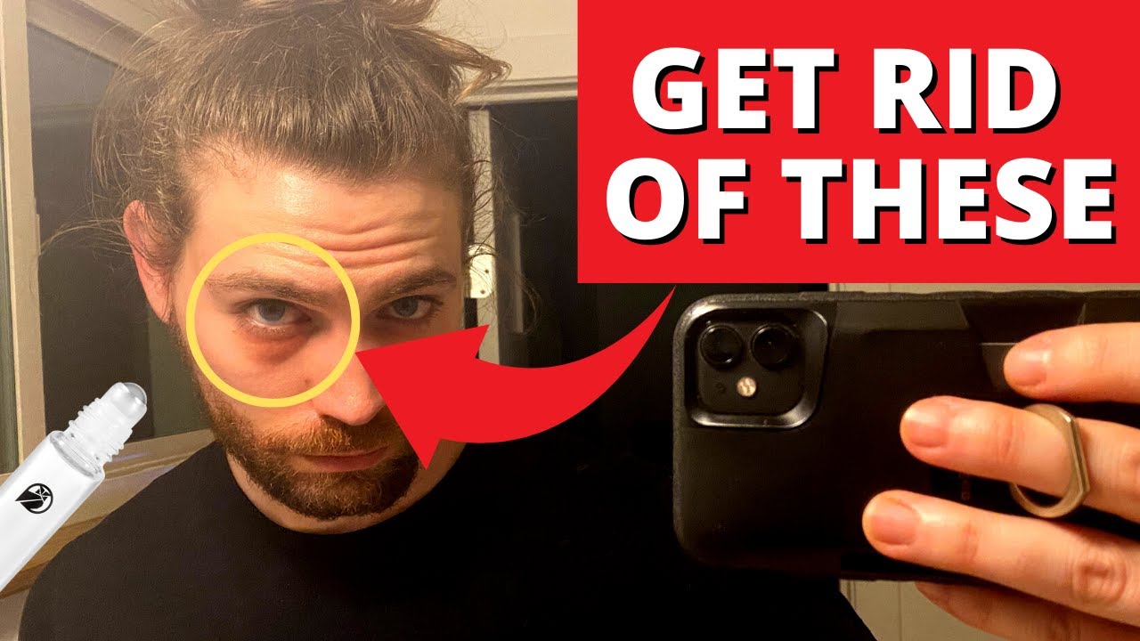 Get Rid Of DARK CIRCLES & BAGS Under Your Eyes (Men's Skincare) - YouTube