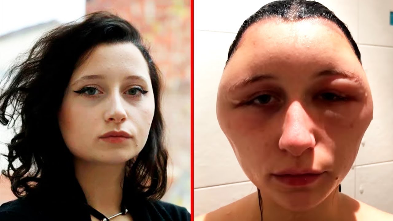 8 Times Allergic Reactions Went Terribly Wrong! - YouTube
