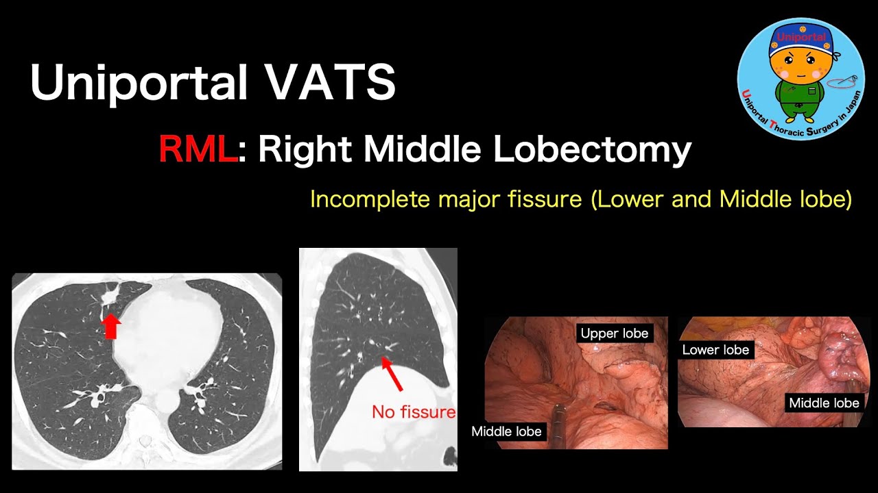 129】Uniportal VATS right middle lobectomy, incomplete major fissure ver ...