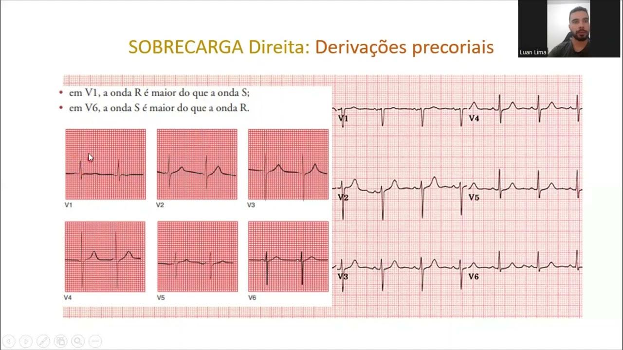 Sobrecarga ventricular no ECG em 10 min - YouTube