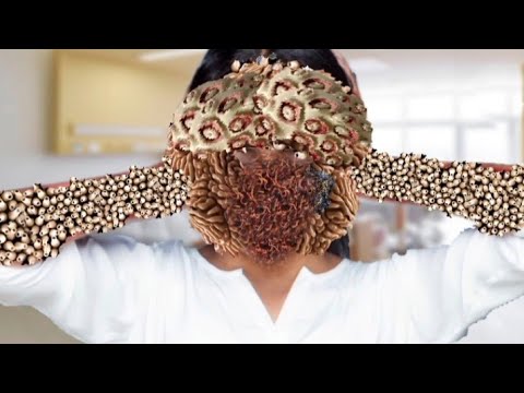 ASMR Remove Big Acne & Worm Infected Face & Hand | Deep Cleaning ...