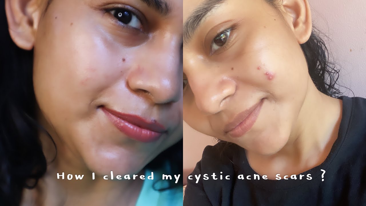 HOW I CLEARED MY CYSTIC ACNE SCARS | LOVEDBYMERCYBIVIN - YouTube