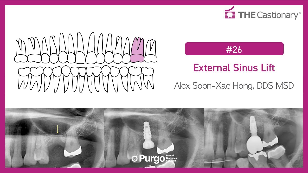 [#26] External Sinus Lift - YouTube