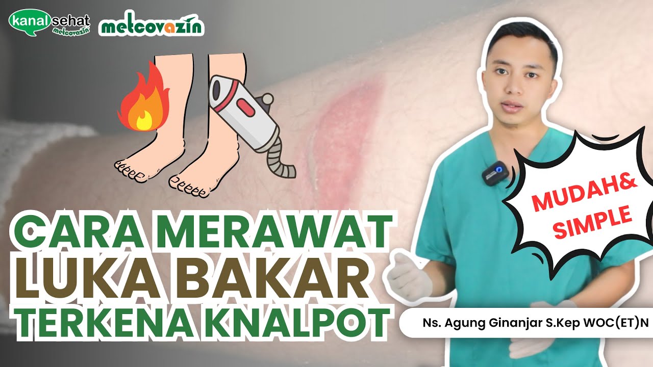 MENGATASI LUKA BAKAR KENA KNALPOT ! | Kanal Sehat by Metcovazin - YouTube