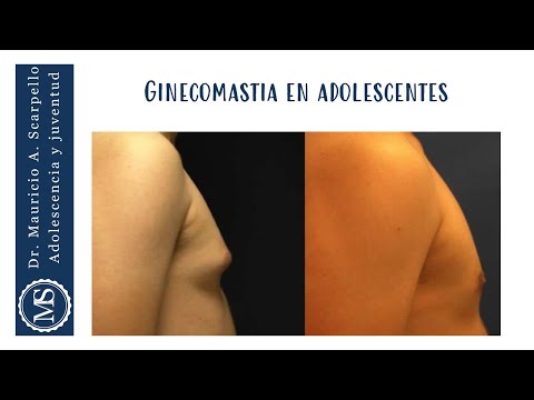Ginecomastia en adolescentes | Crecimiento del pecho en adolescentes