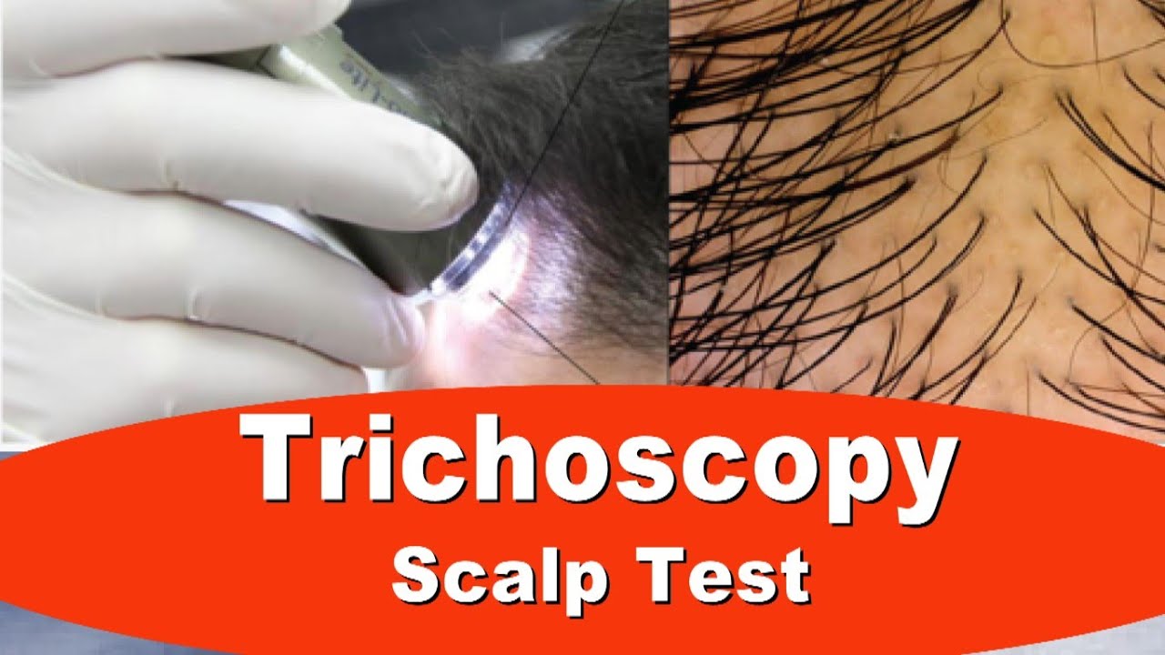 5 Important Observations Of Hair Under Trichoscopy Scalp Dermascopy Dr ...