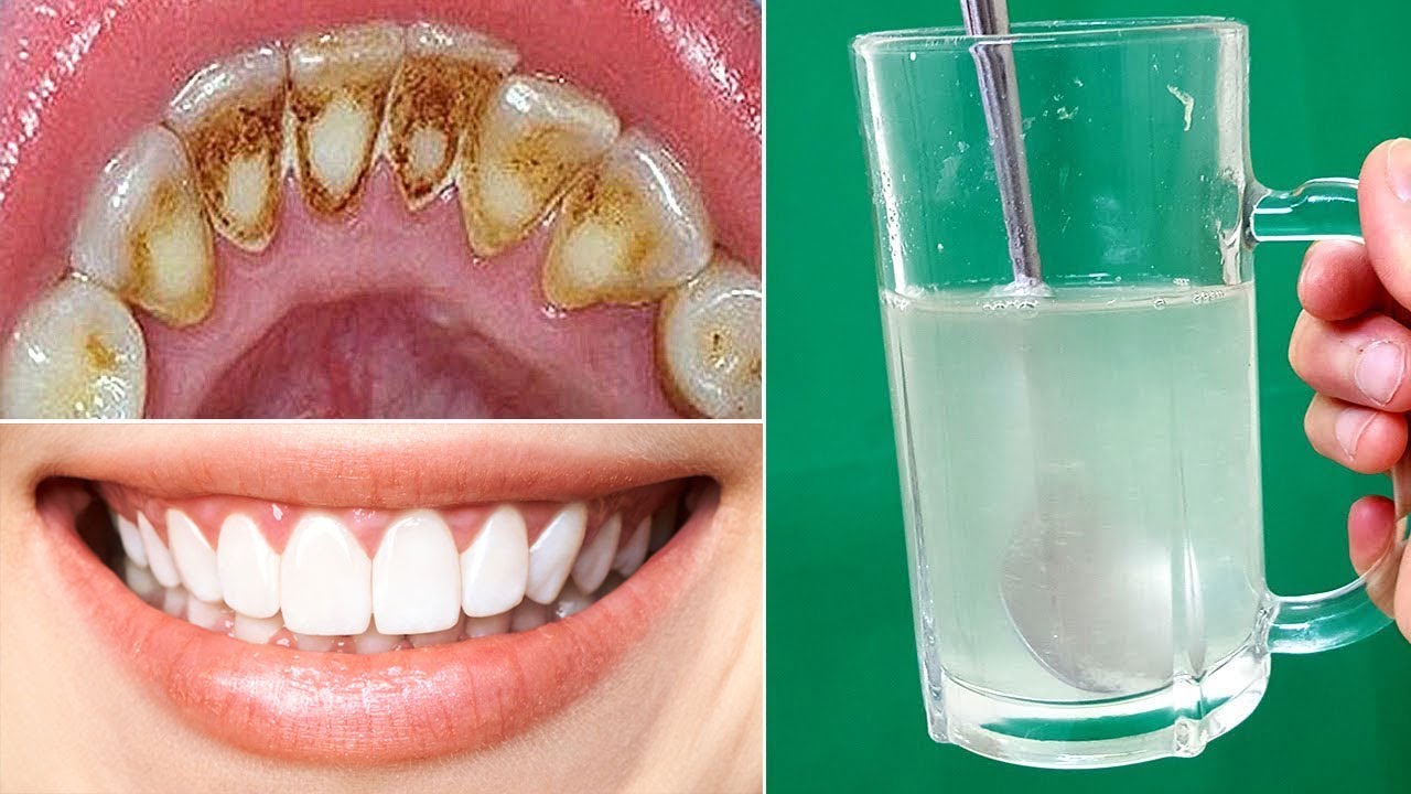 Schau, wie du Zahnbelag und Zahnstein sehr schnell mit diesen ...
