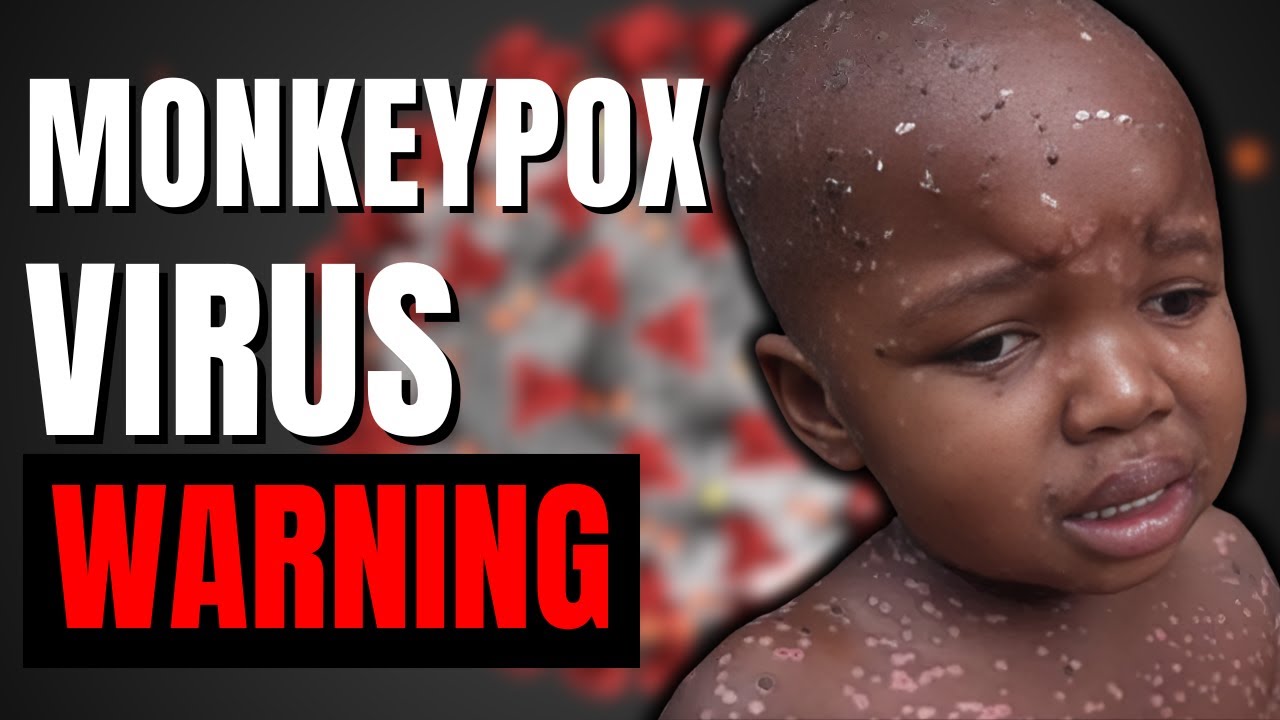 Monkeypox Virus | 7 Things You Should Know About MonkeyPox Outbreak - YouTube
