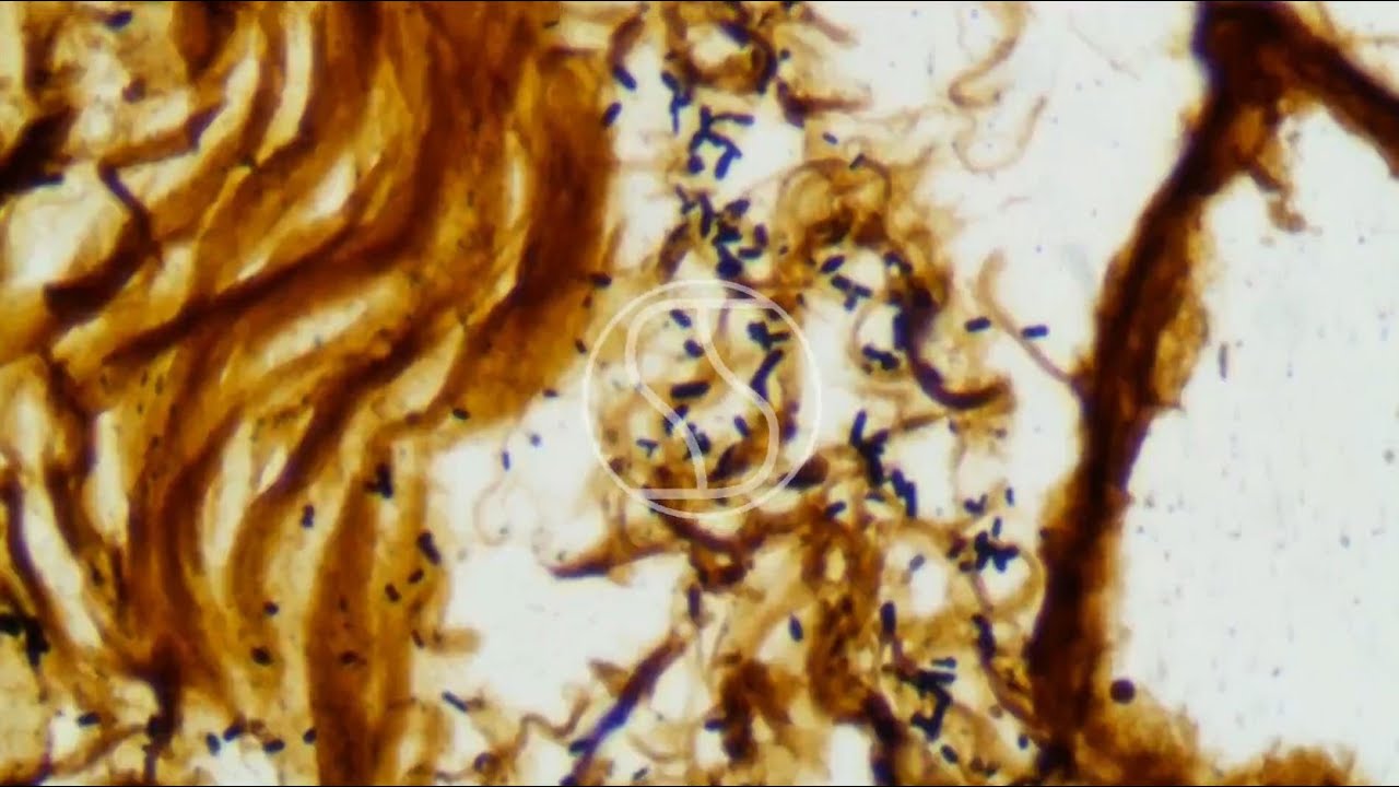 Helicobacter pylori under the microscope with Warthin–Starry stain ...